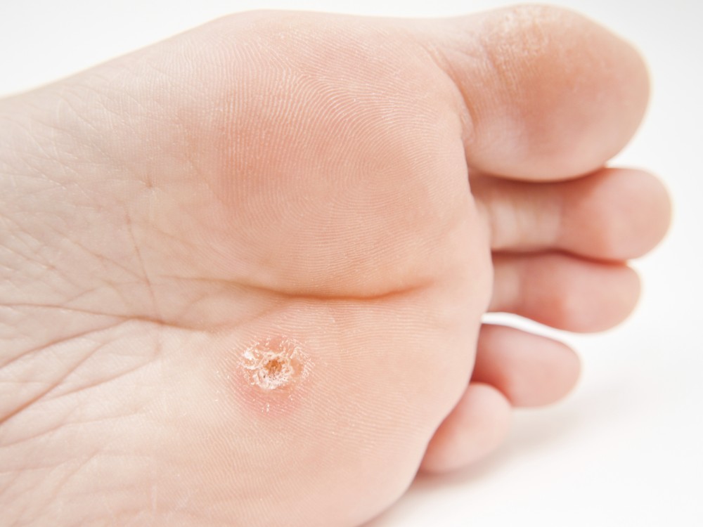 Perform Podiatry - Corns