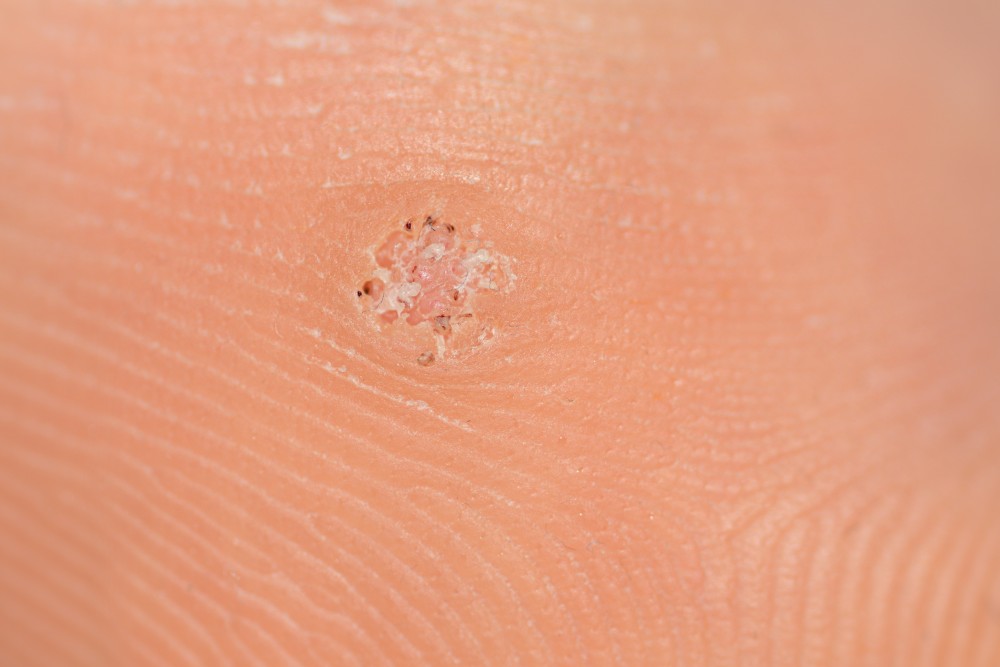 Perform Podiatry - Effective Verruca Treatment: How Conservative Care ...