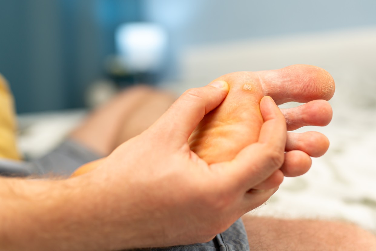 Perform Podiatry - Effective Verruca Treatment: How Conservative Care ...