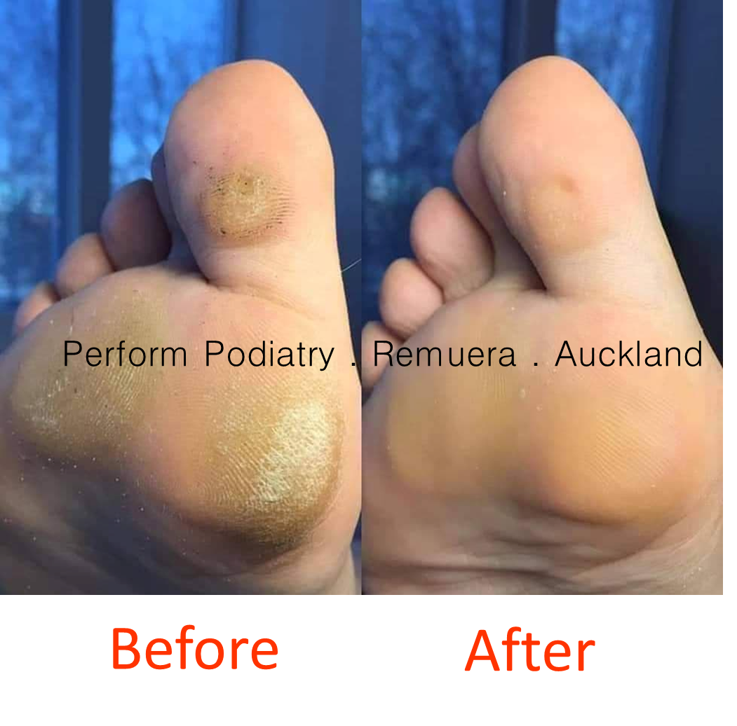 Perform Podiatry - Medical Pedicure: The Safe, Feel-Good Foot Care Mums ...