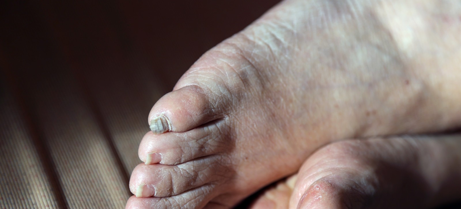 Perform Podiatry - What’s The Best Nail Fungus Treatment In Auckland