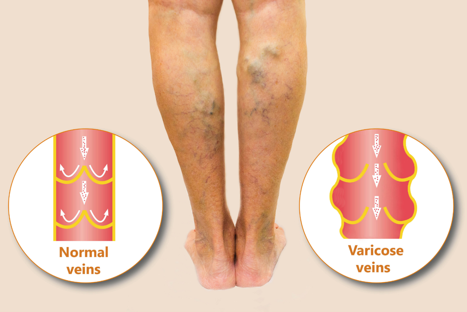 Perform Podiatry - Why Do I Have Noticeable, Dark Veins On My Legs?