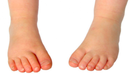 Perform Podiatry - Orthotics for Children: The Gait Plate for In-toeing