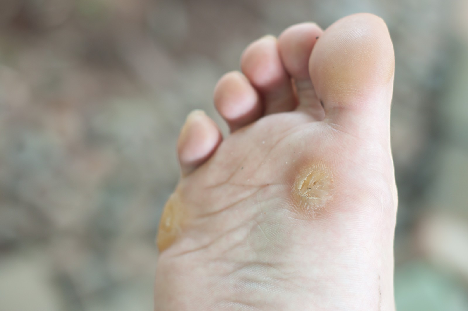Perform Podiatry - Why A Diabetic Foot Check Will Literally Save Your Feet!