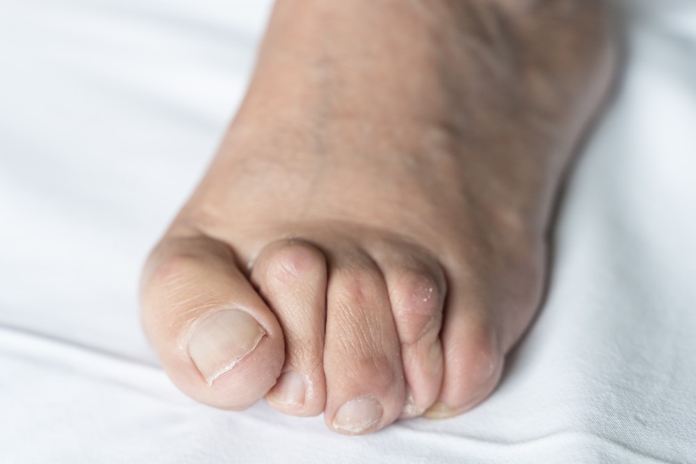 Perform Podiatry - Hammer Toes