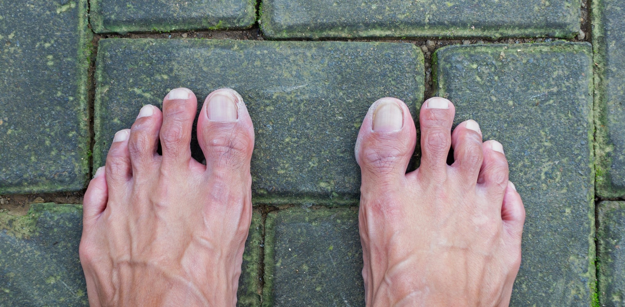 Perform Podiatry - How To Get A Splinter Out Of Your Foot The Right Way